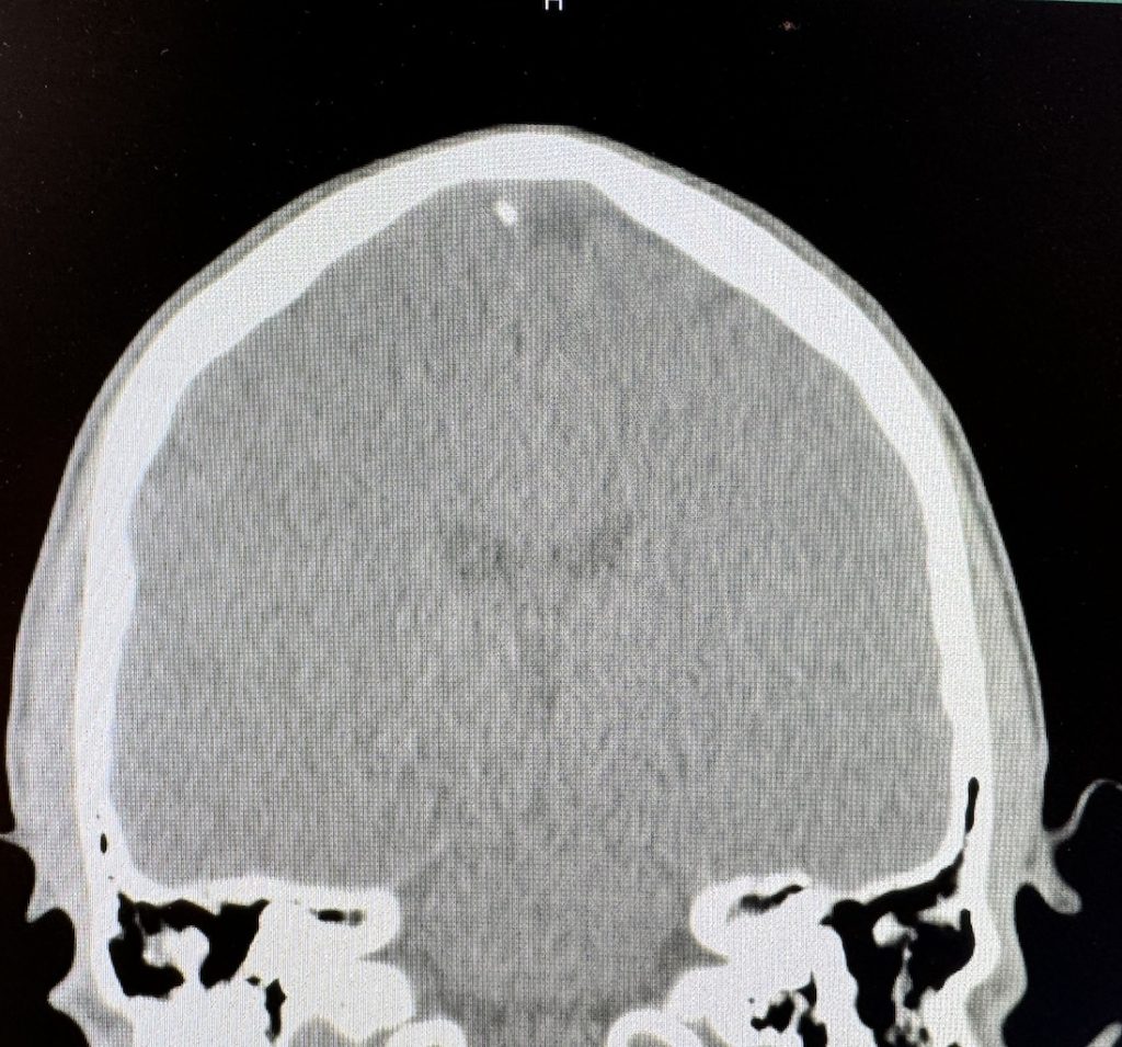 What Is The Best Method To Reduce The Ridge On The Top Of My Head ...