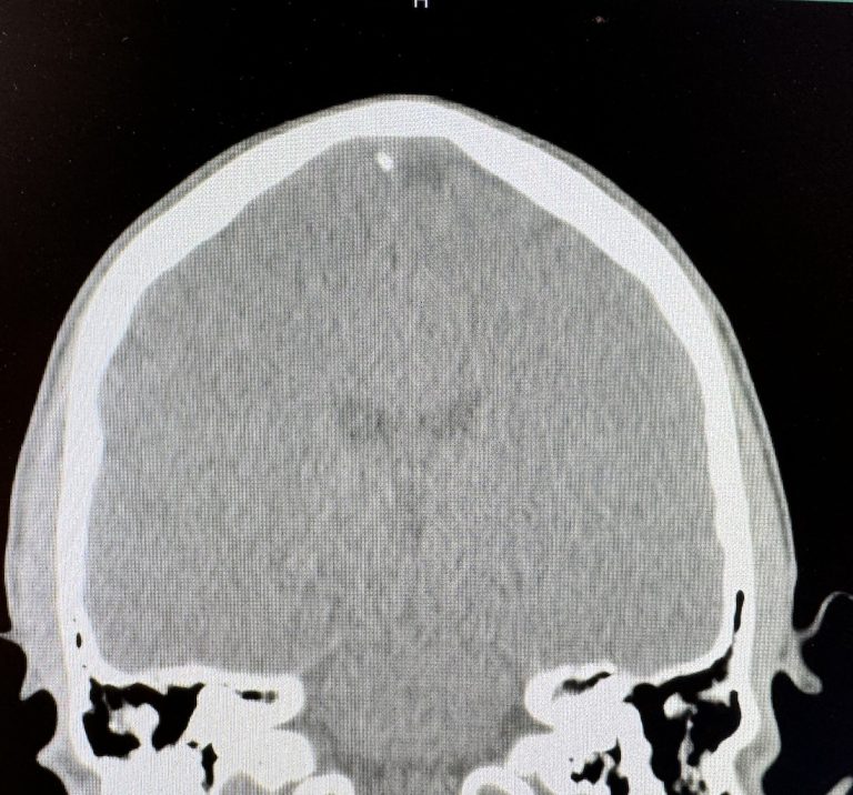 What Is The Best Method To Reduce The Ridge On The Top Of My Head ...