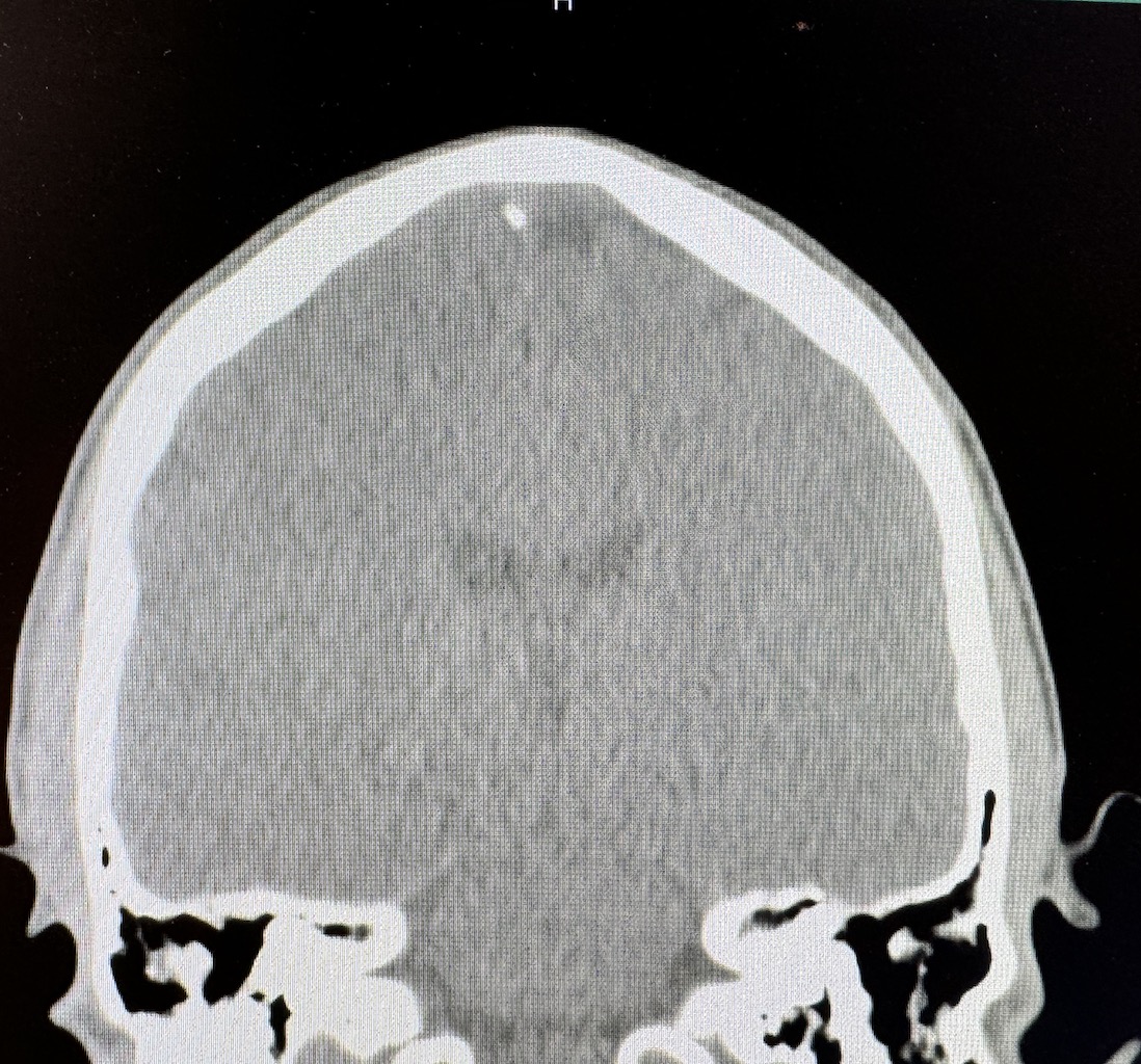What Is The Best Method To Reduce The Ridge On The Top Of My Head ...