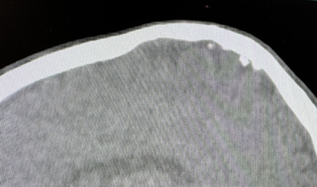 What Is The Best Method To Reduce The Ridge On The Top Of My Head ...