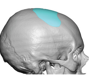 What Does A Coronal Dip Skull Implant Look Like? - Plastic Surgeon | Dr ...
