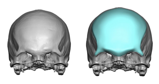 What Is The Cost Of A Brow Bone Implant? - Plastic Surgeon | Dr. Barry ...