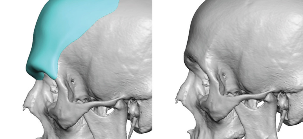 How Can I Fix My Sloped Flat Forehead and Underdeveloped Brow Ridges ...