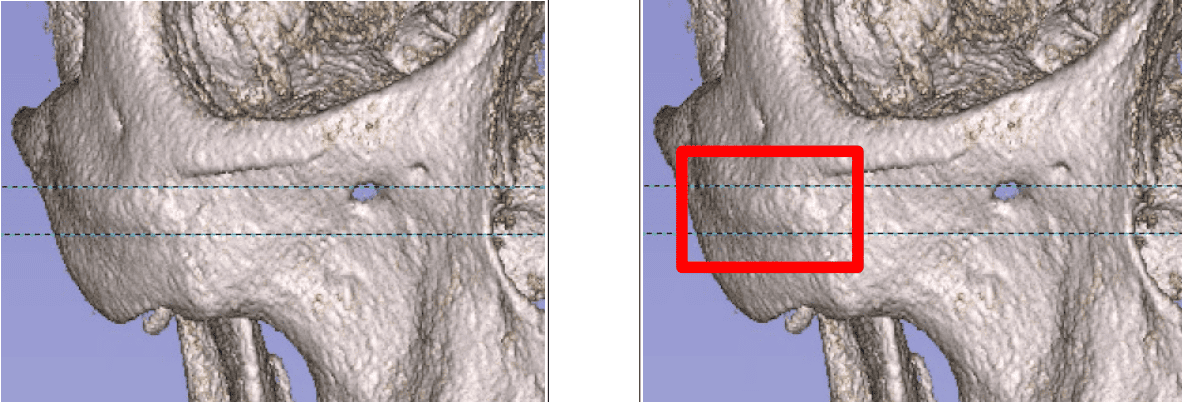 Where Should The Maximum Malar Projection Be In Custom Cheek Implants ...