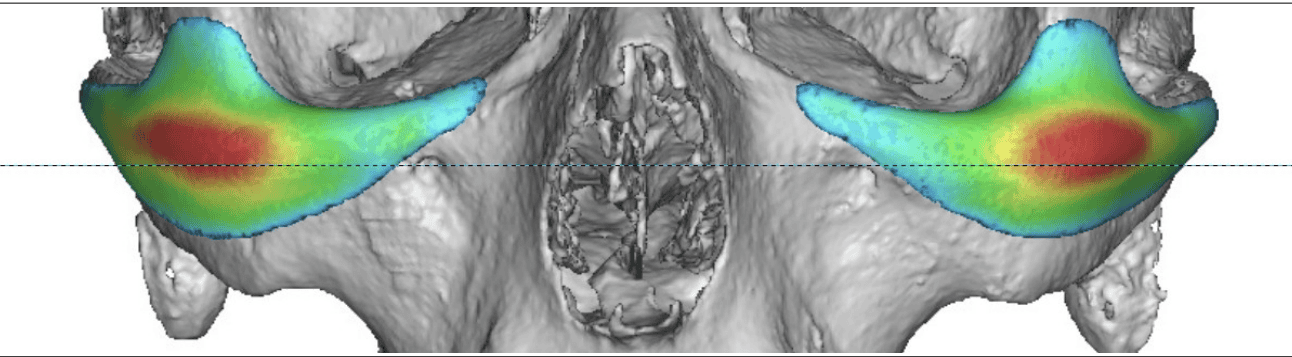 Where Should The Maximum Malar Projection Be In Custom Cheek Implants ...