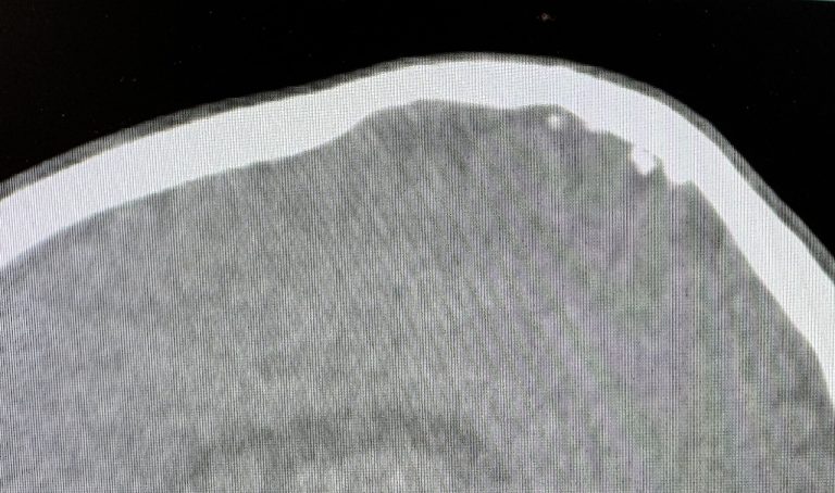 What Does A Coronal Dip Skull Implant Look Like? - Plastic Surgeon | Dr ...