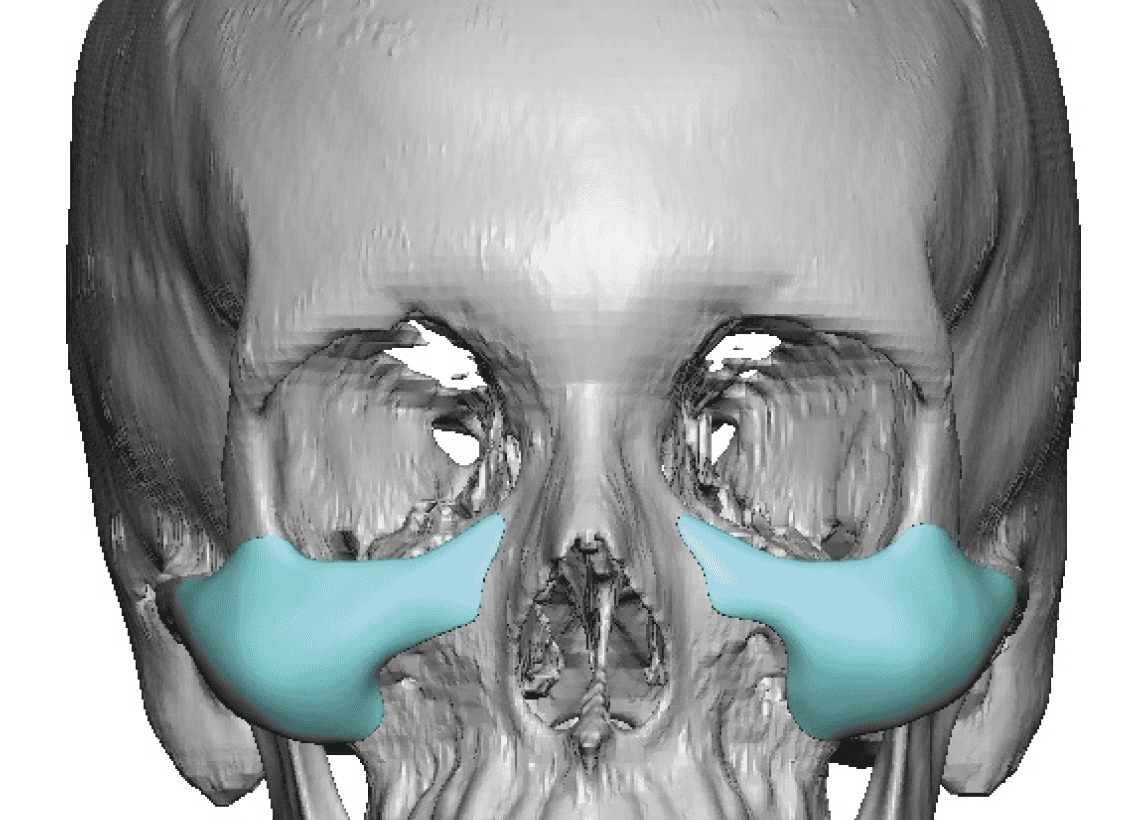 How Can I Fix The Hollowness In My MIdface After A LeFort I Osteotomy ...