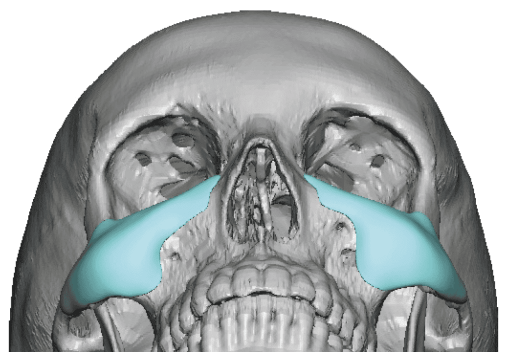 How Can I Fix The Hollowness In My MIdface After A LeFort I Osteotomy ...