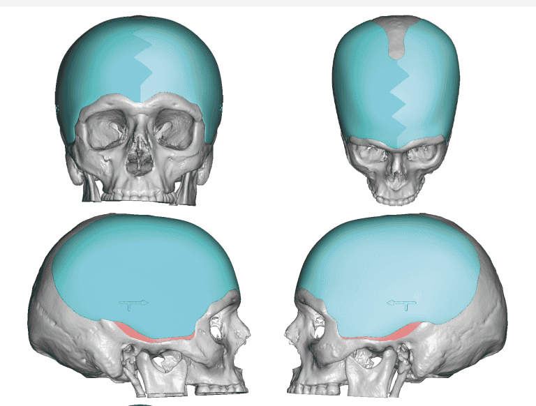 How Can I Make My Head Wider and Taller? - Plastic Surgeon | Dr. Barry ...