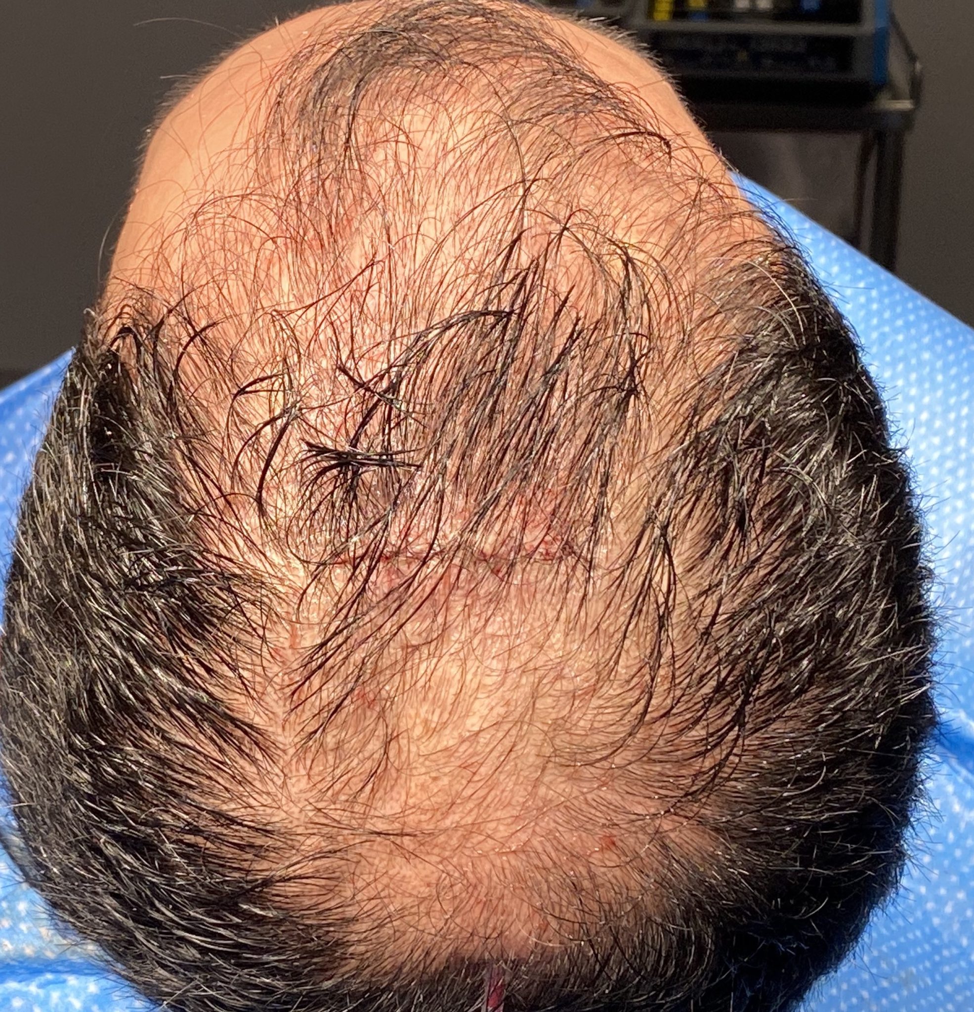 How Bad Is The Scarring From Sagittal Ridge Skull Reductions in a Bald ...