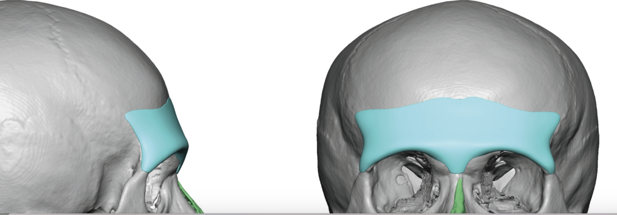 Can I Get A Custom Brow Bone Implant? - Plastic Surgeon | Dr. Barry L ...