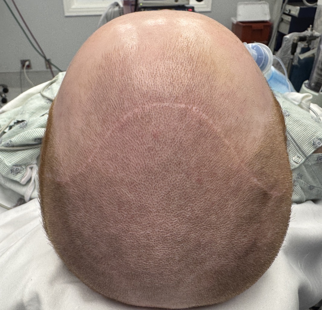 Can The Anterior Temporal Muscle Be Reduced With A Hemi-Coronal Scalp ...