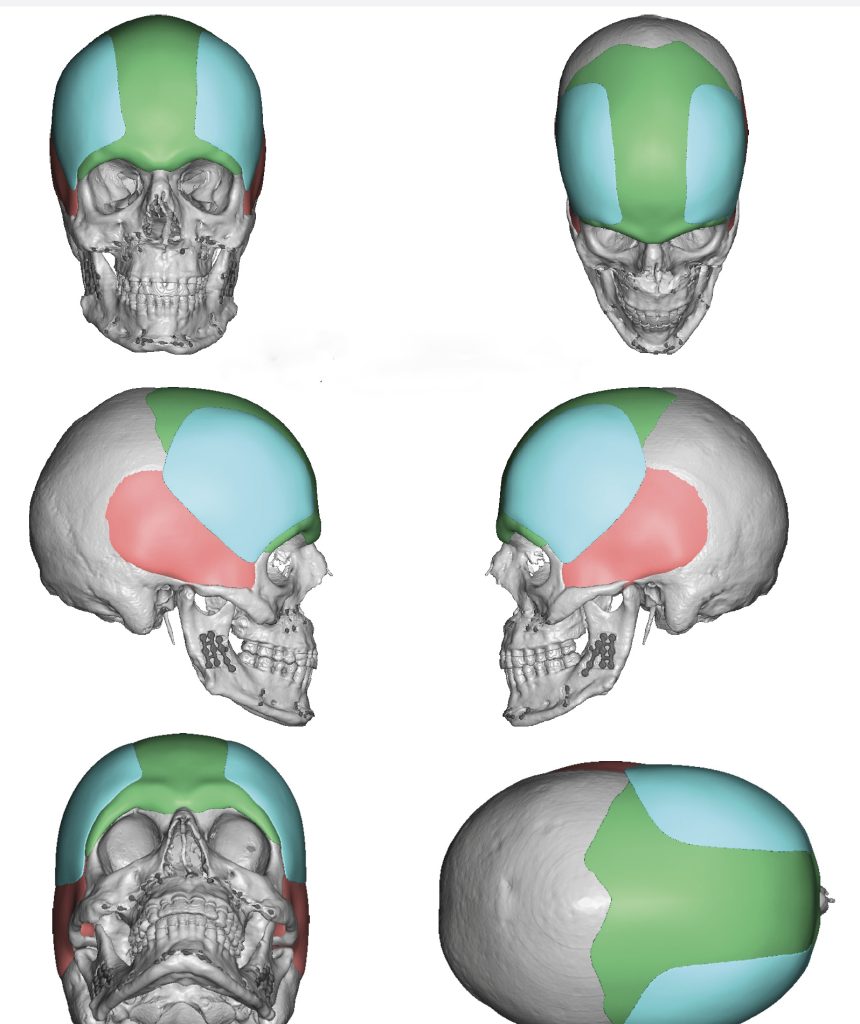 How Can My Forehead Bone Made Wider? - Plastic Surgeon | Dr. Barry L ...