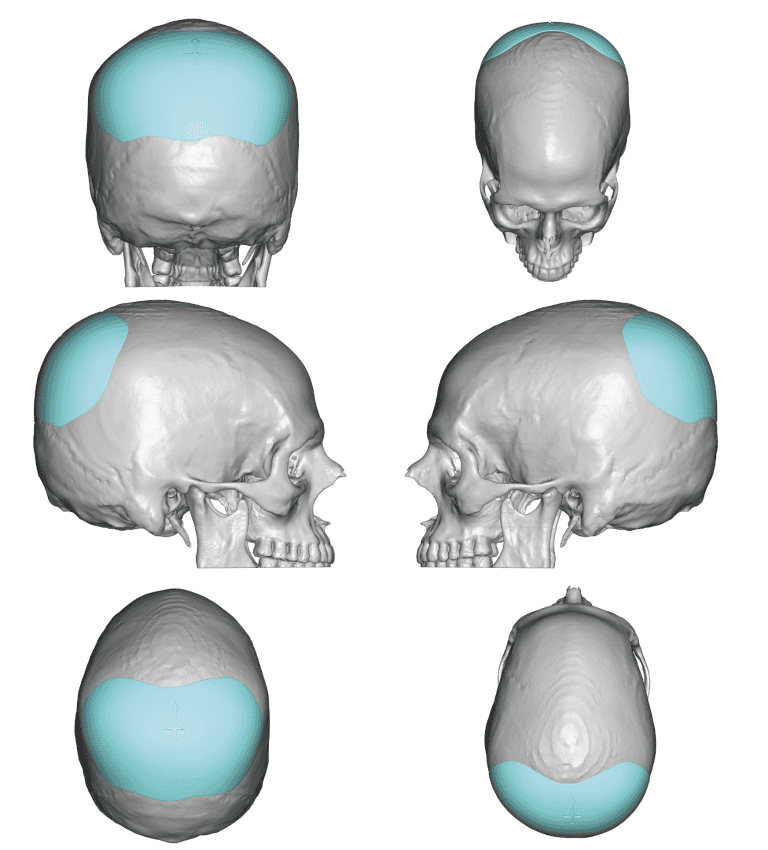 How Can My Parietal Skull Indents Be Fixed? - Plastic Surgeon | Dr ...