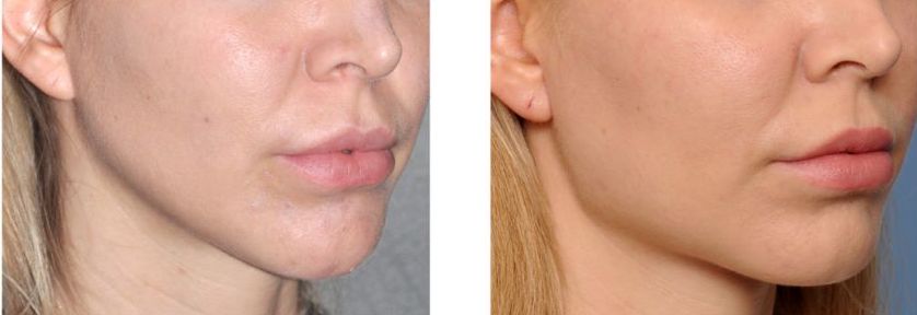 How Can I Make My Jaw Angles More Angular? - Plastic Surgeon | Dr ...