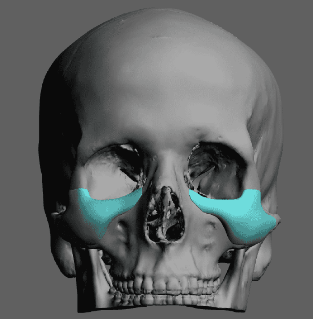 How Can My Negative Orbital Vector and Sagging Lower Eyelids Be Fixed ...