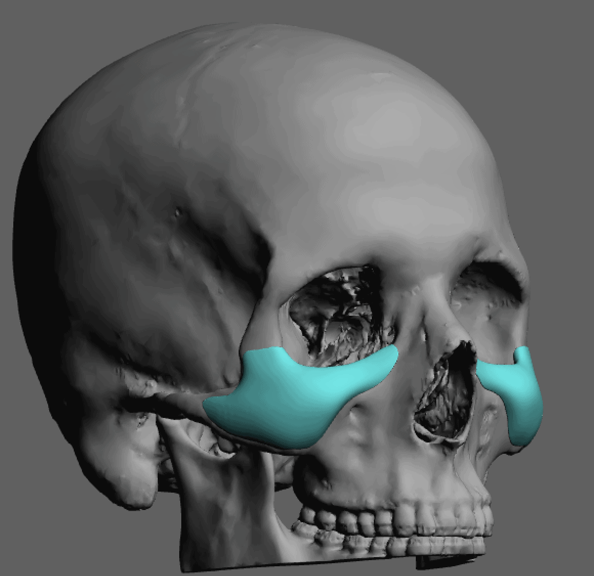 How Can My Negative Orbital Vector and Sagging Lower Eyelids Be Fixed ...