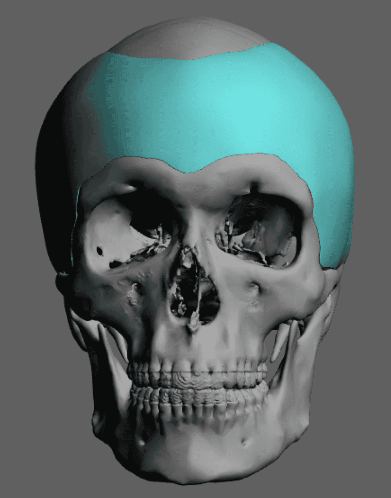 Can I Make My Narrow Forehead and Temples Wider? - Plastic Surgeon | Dr ...